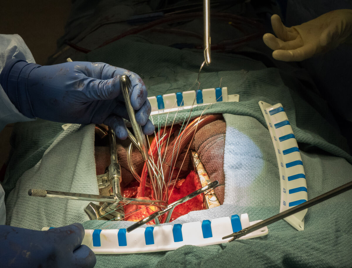 open heart surgery II: The completion of the mitral valve placement ...