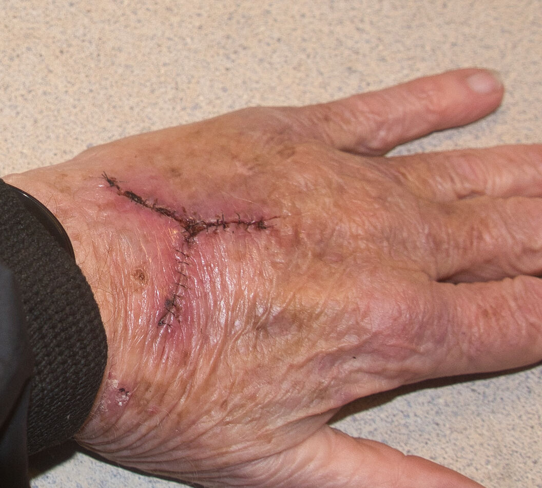 Mercedes Closure: I had a spot removed from my hand a few months ago ...